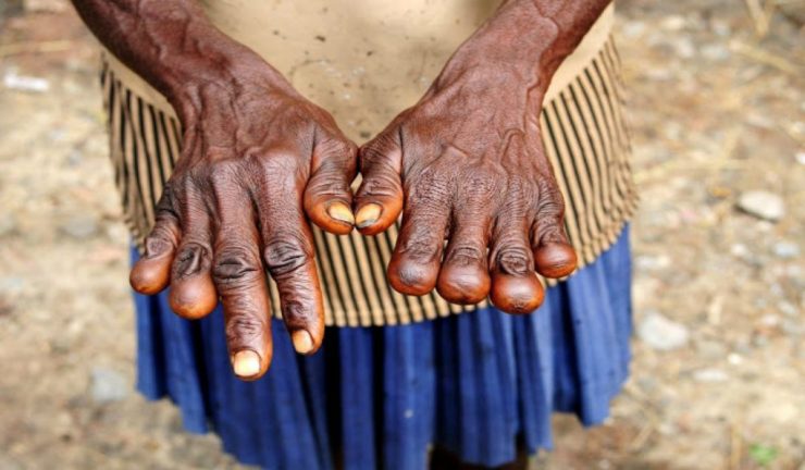 'FINGER CUTTING RITUAL' A Weird Custom When The Loved One Dies, Dani Tribe